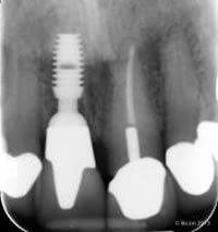 Bicon dental implants